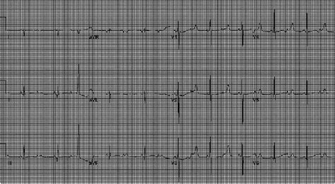 Electrocardiogram With Sinus Rhythm With A Prolonged Corrected Qt
