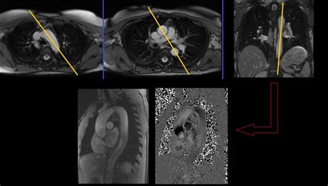 Cardiac Mri Flow Quantification Protocols Planning And Techniques