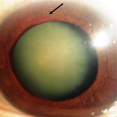 Preoperative Biomicroscopic Examination Note The Extensive Iris Download Scientific Diagram