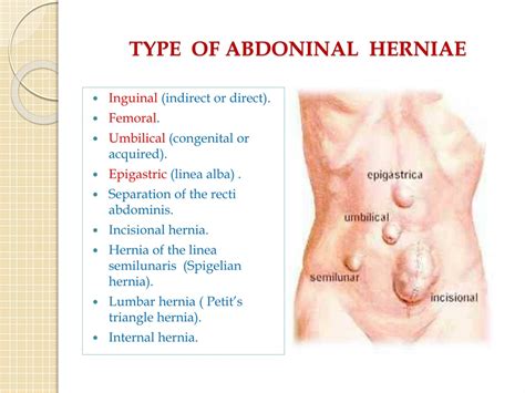 Ppt Abdominal Herniae Powerpoint Presentation Free Download Id8782652
