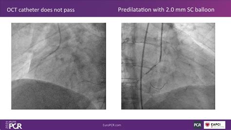Cracking The Calcium Code Novelty And Utility Of Hertz Contact Intravascular Lithotripsy