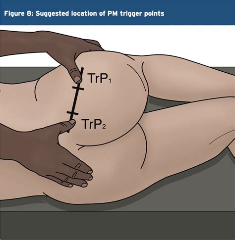 Piriformis Muscle A Vicious Syndrome El Paso TX Doctor Of Chiropractic