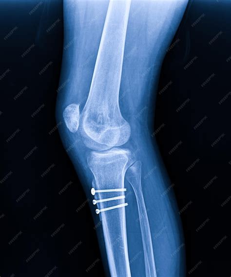 Premium Photo Xray Knee Joint Fracture Proximal Tibia And Post Fix Fracture Proximal Tibia