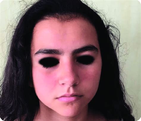 A Mild Linear Depression At The Forehead And An Atrophy At The Left Download Scientific