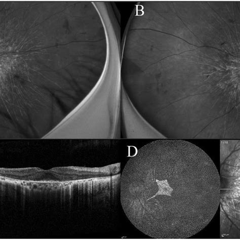 retinal layer segmentation on heidelberg spectralis sd oct machine a