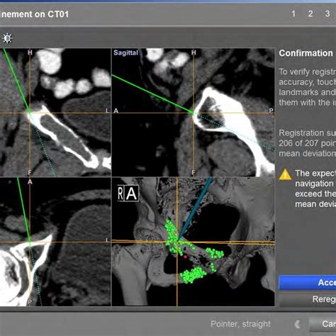 Entry Point And Trajectory Chart For Thoracic Pedicle Screw Placement Download Scientific