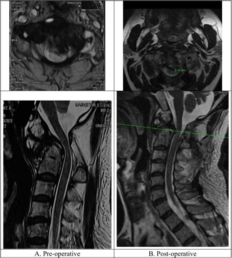 Pre And Postoperative Mri A Pre Operative Show Spinal Cord