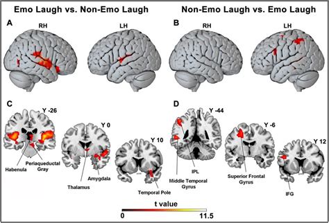 Cortical And Subcortical Activations Enhanced By The Emotional Laughing