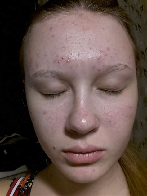 Что обозначают прыщи на лице фото