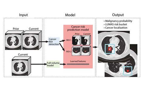 Artificial Intelligence In Lung Cancer Opening New Avenues For
