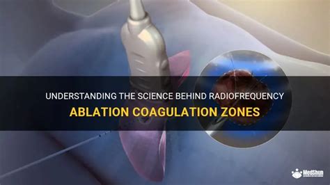Understanding The Science Behind Radiofrequency Ablation Coagulation