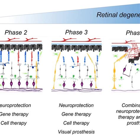 Progression Of Retinal Degeneration The Healthy Retina Consists Of Download Scientific Diagram