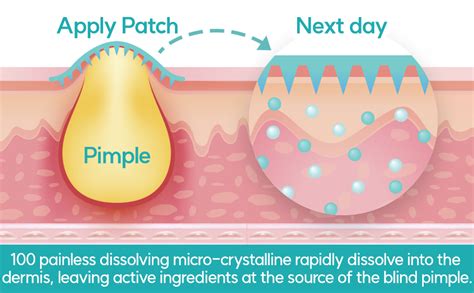 Amazon Com VILVIN Microdart Acne Patch For Deep Blemish Patches