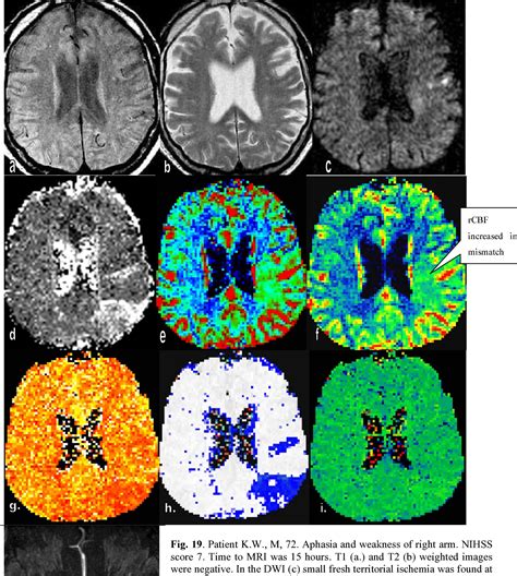 Figure 1 From Diffusion And Perfusion Weighted Magnetic Resonance Imaging In Patients With