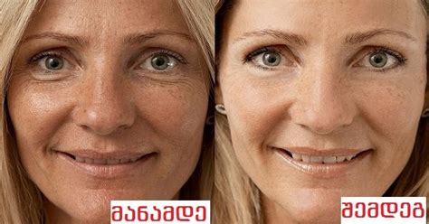 სოლკოსერილი ახალგაზრდა ელასტიური კანისთვის ბოტოქსზე ყველა ფიქრი გაქრება სასარგებლო რჩევები