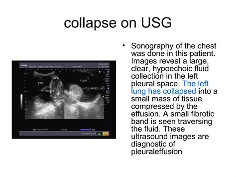 Collapse And Consolidation Lung Radiology Ppt