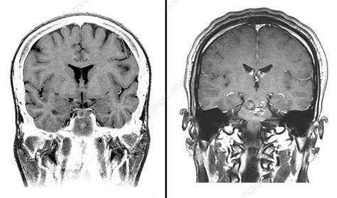 Mri Of Normal Brain And Ms Lesions Stock Image C027 2389 Science