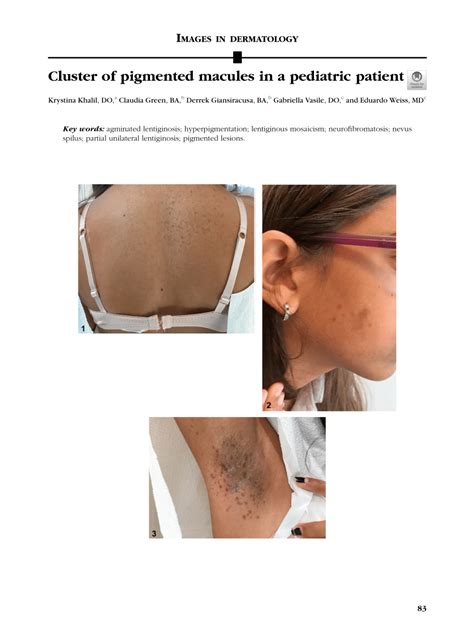 Pdf Cluster Of Pigmented Macules In A Pediatric Patient