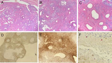 Nódulo En La Rodilla Piel Formación Continuada En Dermatología