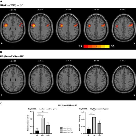 The Functional Connectivity Between The Right Ipl And Whole Brain