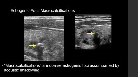 Thyroid Imaging Reporting Data System PPTX