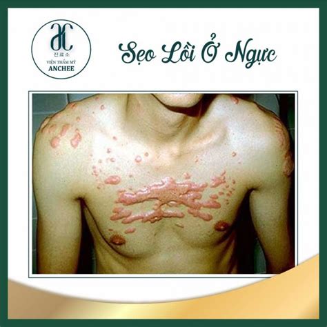Sẹo Lồi Ở Ngực Nguyên Nhân Và Cách Trị Sẹo Hiệu Quả