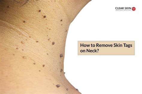 At Home Skin Tag Skin Tags Symptoms Causes Diagnosis Treatment