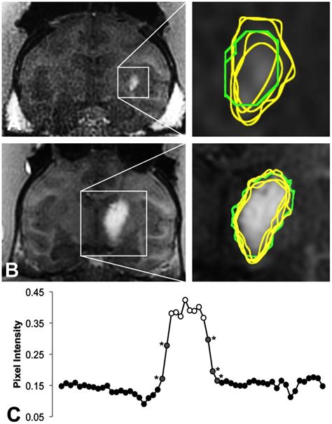 The Automated Segmentations Were More Consistent In Both A A A 50 µl Download Scientific