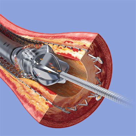 Arterial Disease Treatment Monterey Bay Aptos And Salinas Ca