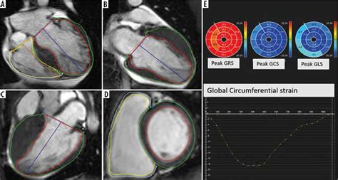 Feature Tracking Cardiac Magnetic Resonance Method A Valuable Marker