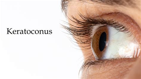 Keratoconus Specialist Long Beach Cornea Surgeon Socal Eye