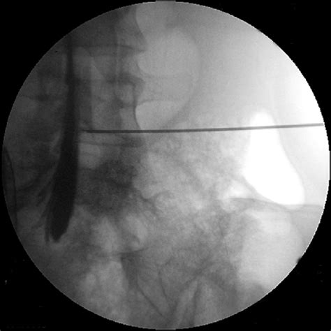 Intra Operative Fluoroscopic Imaging Showed Intrathecal Administration Download Scientific