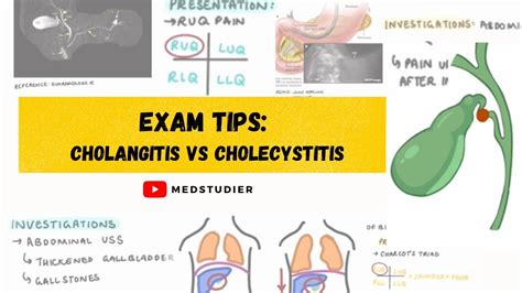 Cholangitis Vs Cholecystitis Cholecystitis Vs Choledocholithiasis Vs