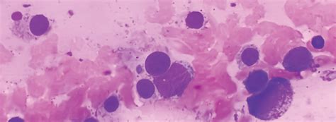 Rna Based Diagnosis And Treatment Of Multiple Myeloma Norgen Biotek Corp