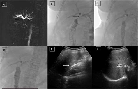 Early Biodegradable Stent Placement For Percutaneous Hepaticojejunostomy Stricture Management