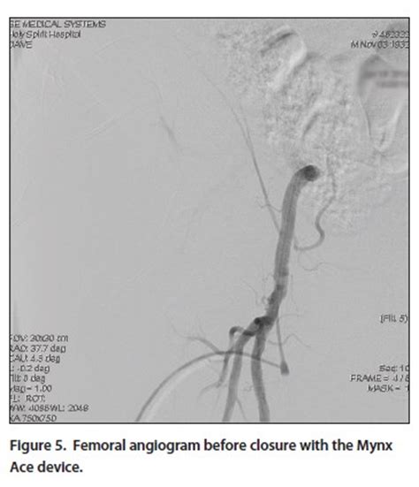 The MYNX ACE Vascular Closure Device Endovascular Today