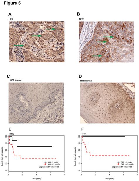 Hfe And Tfr1 Expression In Hnscc Patient Samples A A Representative