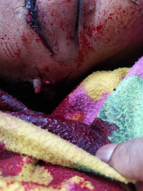 မတ္တရာမှာ စစ်တပ်ကပစ်တဲ့ လက်နက်ကြီးကျည်ထိလို့ ပြည်သူ ၁ ဦးသေပြီး ၂ ဦးဒဏ်ရာရ