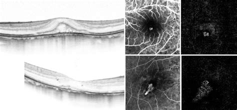 Detection Of Myopic Choroidal Neovascularization Using Optical