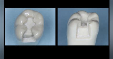 Reducing Caries In Proximal Boxes Of Class Ii Resin Restorations