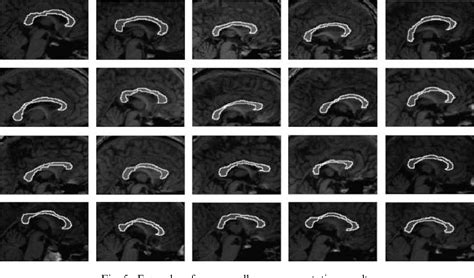 Figure 1 From Watershed Segmentation Using Prior Shape And Appearance Knowledge Semantic Scholar