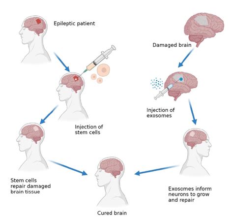 Stem Cell And Exosome Methods Of Use To Treat Epilepsy The Following