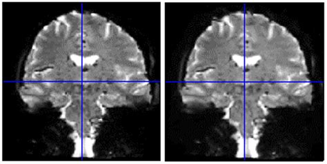 The Effect Of Echo Planar Imaging Epi Distortion Correction On The Download Scientific