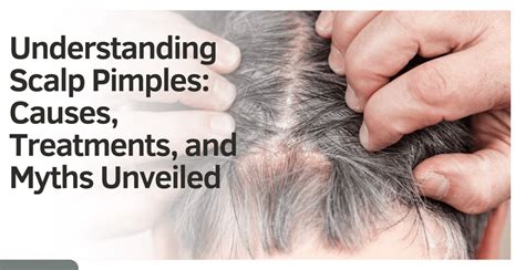Understanding Scalp Pimples Causes Treatments And Myths Clinikally