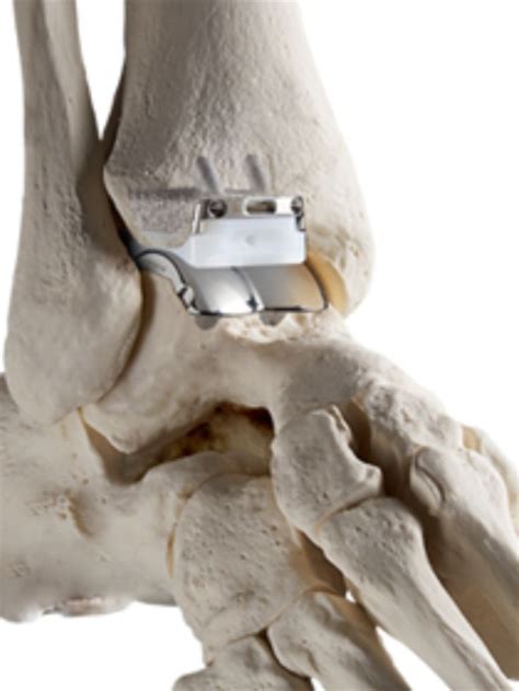 Ankle Replacement Artofit