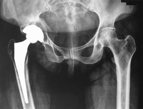 Hip Replacement Udai Omni Hospital