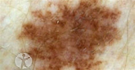 Reticular Pattern Dermoscopy Image