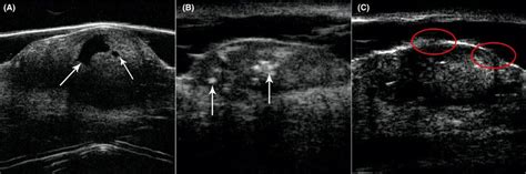 A Anechoic Areas Arrows A Nodular Bcc On Right Cheek Examined By
