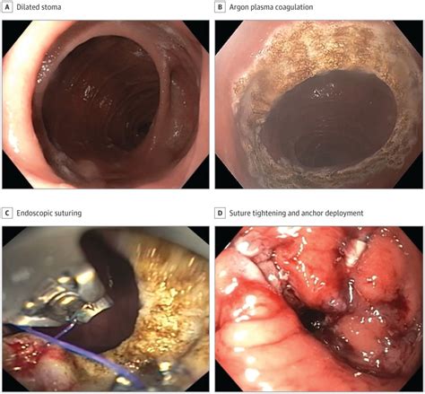 Jama Surgery On Linkedin Endoscopic Gastric Bypass Revision