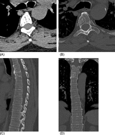 Axial Ct Sections Of The Dorsal Spine In A Soft Tissue Window Setting